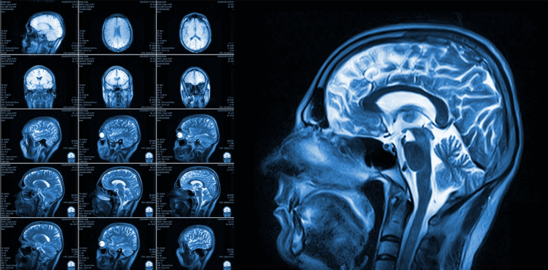 Does Your Whole Body Go In for a Brain MRI? All You Need to Know - Scanny
